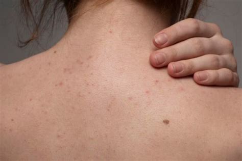 Cystic Acne Back Treatment Bacne 101 Everything You Should Know About