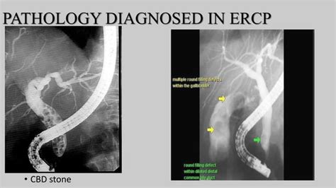 Procedure Of Ercp And T Tube Cholangiography Pptx