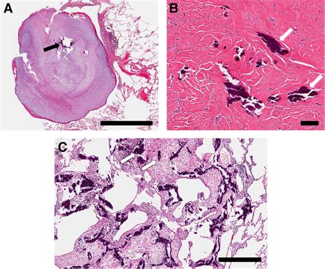 Histopathologic Examples Of Pulmonary Calcifications A Download