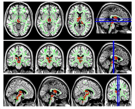 Group Differences In Radial Diffusivity Rd The Rd Values In