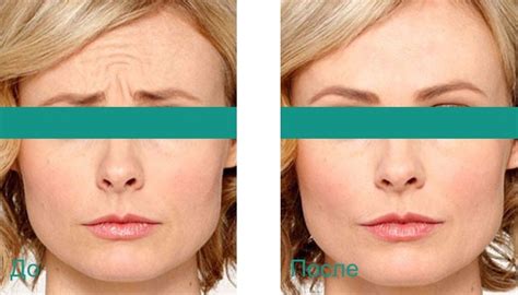Уколы Ботокса (Botox) - сделать инъекции Ботокса в Москве, цены на курс ...