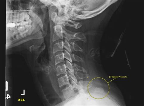Spinous Process Fracture