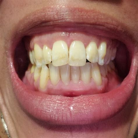 Can Invisalign Correct Midline Misalignment In Adults
