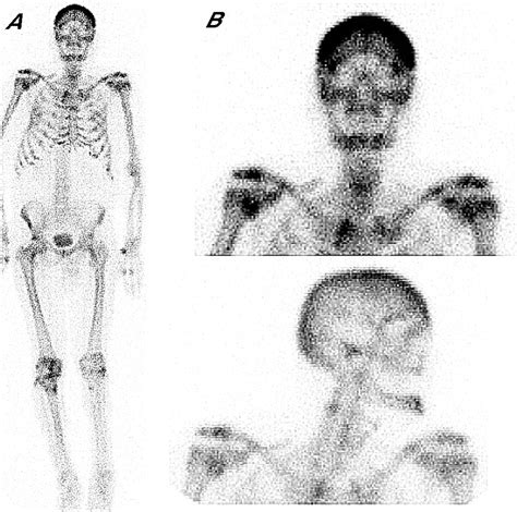 Hyperparathyroid Bone Disease—an Unusual And Memorable Condition