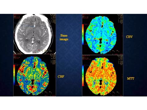 Ct Perfusion Pptx