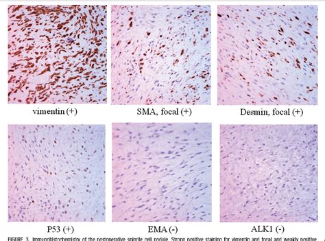 [pdf] Postoperative Spindle Cell Nodule After Thyroidectomy A Case Mimicking Recurrence With