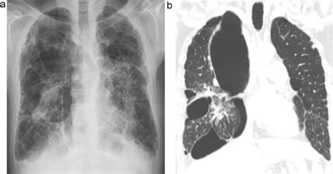 Localized Pneumothorax In A 58 Year Old Patient With Coal Workers Download Scientific Diagram