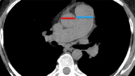 Comorbid Conditions On Hrct Ild Radiology Rounds