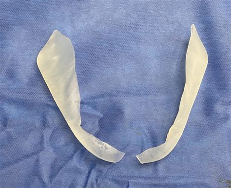 Plastic Surgery Case Study Reshapingderotating The Steep Mandibular