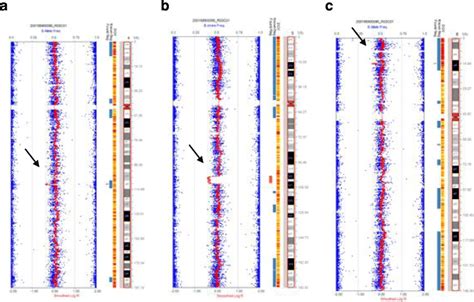 The Snp Array Results Of The Patient Microdeletions On Chromosome 4