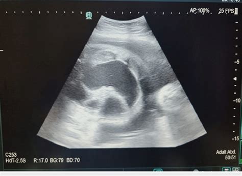Antenatal Scan Showing Dilated Bowel Loops Download Scientific Diagram