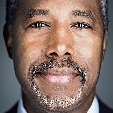 Craniopagus Tweelingen Gescheiden Door Ben Carson