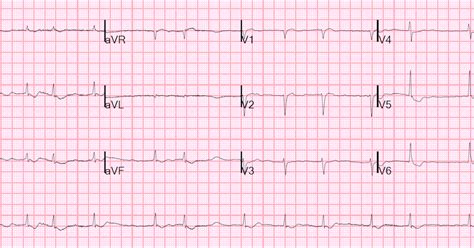 Digoxin T Wave