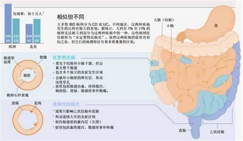 赛医尚道：炎性肠病（ibd）与肠道 激动”的免疫反应微生物