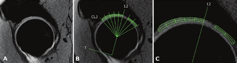 Selection Of Rois In Acetabulum For Statistical Analysis Of T2 Data A