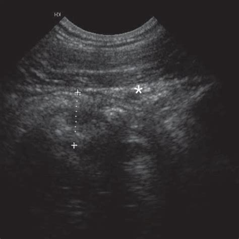 Section Of The Appendix Hyperplasia Of The Lymphatic Tissue Is Evident Download Scientific