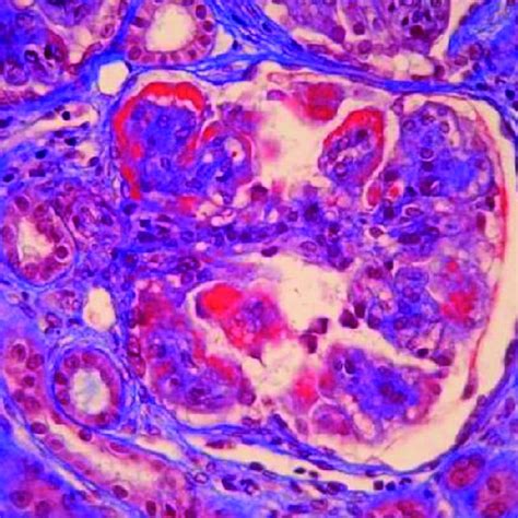 Glomerulus With Intense Global Hypercellularity And Subendothelial