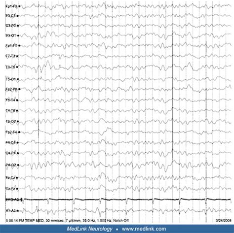 Eeg In Encephalopathic Conditions Medlink Neurology