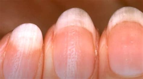 Nail Pitting Causes Treatment And More