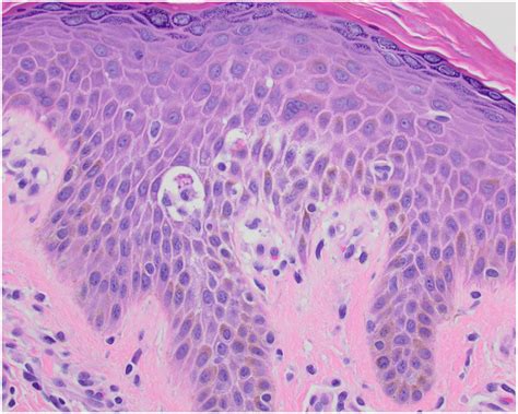 Epidermal Spongiotic Langerhans Cell Collections But Not Eosinophils