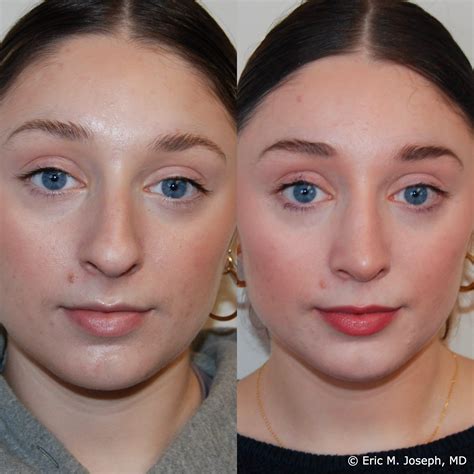 Eric M Joseph Md Rhinoplasty Before And After Natural Rhinoplasty Surgery Results