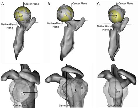 The 3 Dimensional Glenohumeral Subluxation Index 3d Ghsi Determined