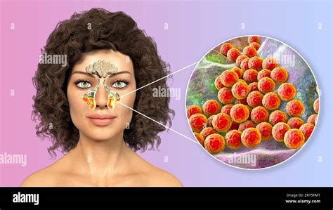 Staphylococcus Aureus Bacteria As A Cause Of Sinusitis Computer Illustration Showing