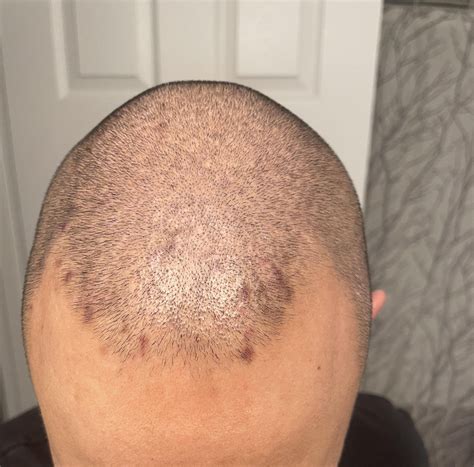 Folliculitis On Head Rfolliculitis