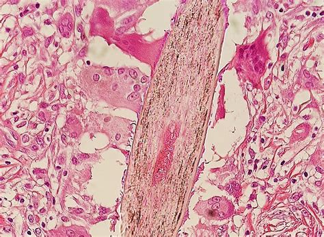 Folliculitis Wikiwand