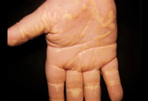 Xanthomatose Xanthome