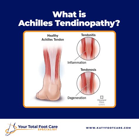 Achilles Tendonitis