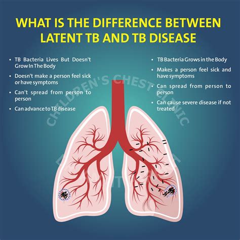 Latent Tuberculosis Contagious
