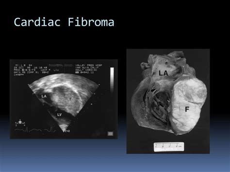 Ppt Evaluation Of Cardiac Masses Powerpoint Presentation Free