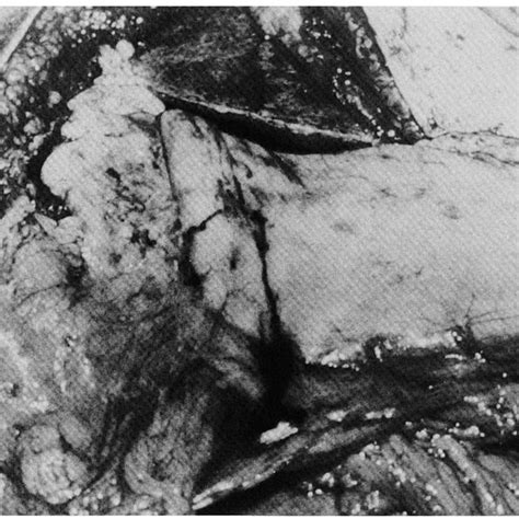 Visual Lymphogram In A Normal Volunteer Patient The Gastric Lymphatics