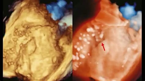 Photorealistic Imaging Enhances 3d Echo Philips