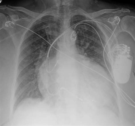 Congenital Rubella Pda