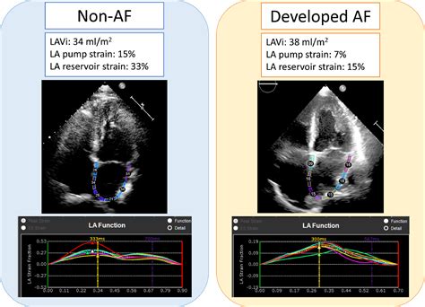 Predictive Value Of Left Atrial Function For Latent Paroxysmal Atrial