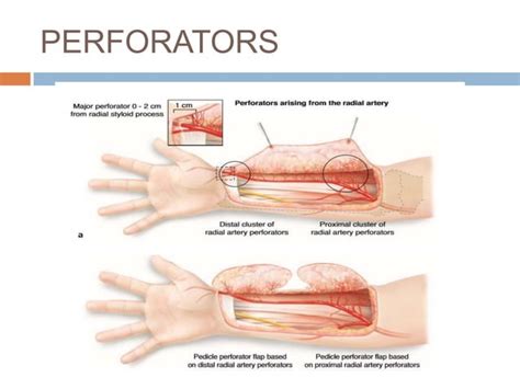 Radial Forearm Flap Pptx