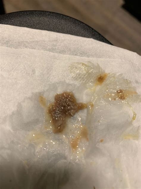 Sinus Infection Mucus Chunk Sinus Infection Sinusitis Mucus