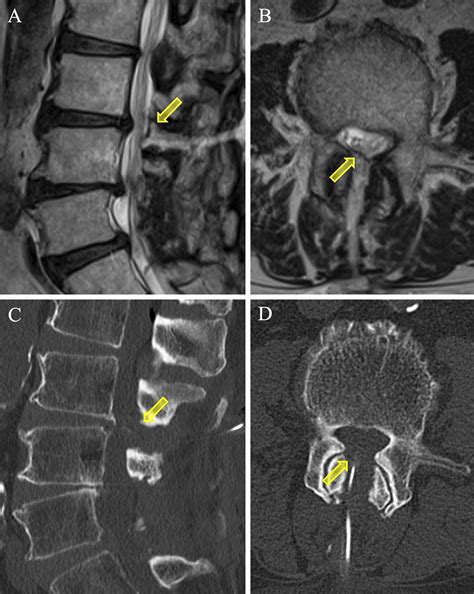 Full Endoscopic Removal Of A Lumbar Synovial Cyst After Laminectomy For