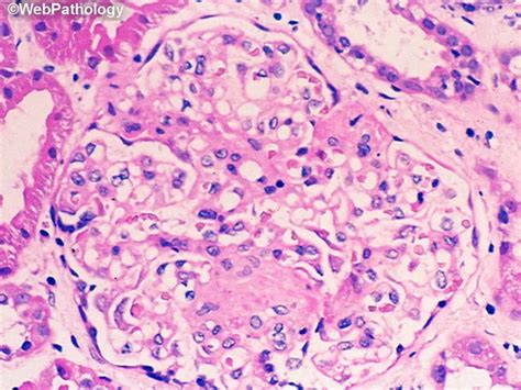 Focal Segmental Glomerulosclerosis