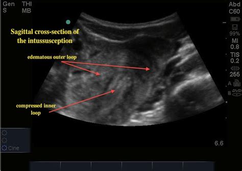 Emory Emergency Ultrasound Intussusception