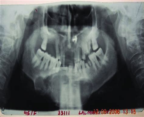 Orthopantomograph Showing Multilocular Radiolucency Extending From 36