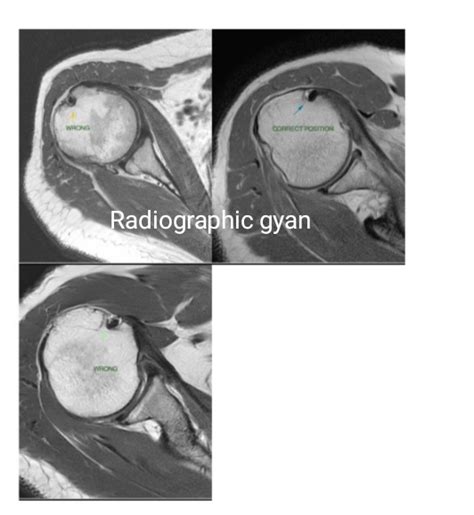 Radiographicgyan Mri Shoulder Planning And Sequencing