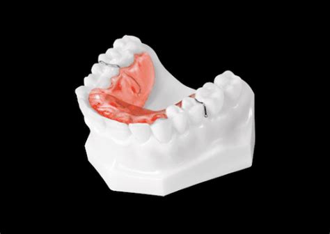 What A Bite Plate Is And How It Can Help