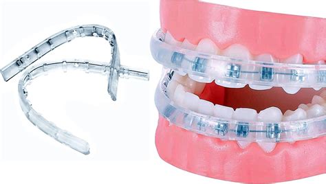 Buy Clip On Comfort Covers For Braces Braces Cover Lip Protector