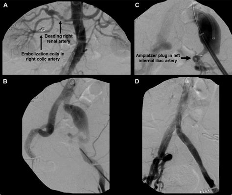 Endovascular Repair Of Left Common Iliac Artery Aneurysm A Abdominal