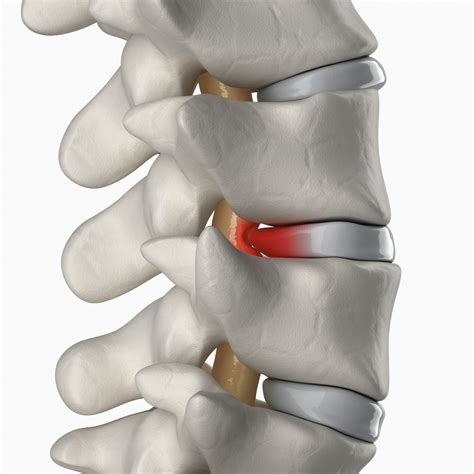 Discseel Procedure For Bulging Discs In Wisconsin Innovative Relief