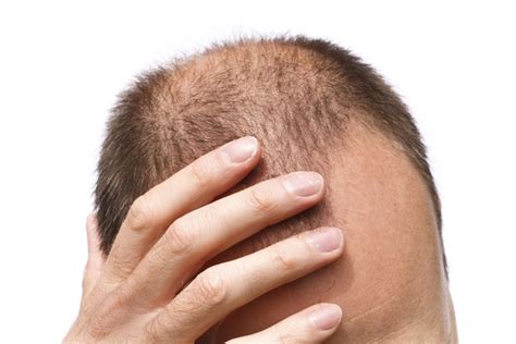 Hair Loss And Prostate Drugs Linked To Persistent Erectile Dysfunction In Men Northwestern Now