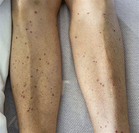Multiple Purpuric Macules And Papules Of Septic Leukocytoclastic Download Scientific Diagram